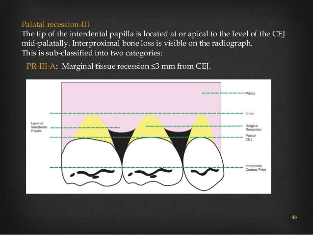 Gingival recession classifications