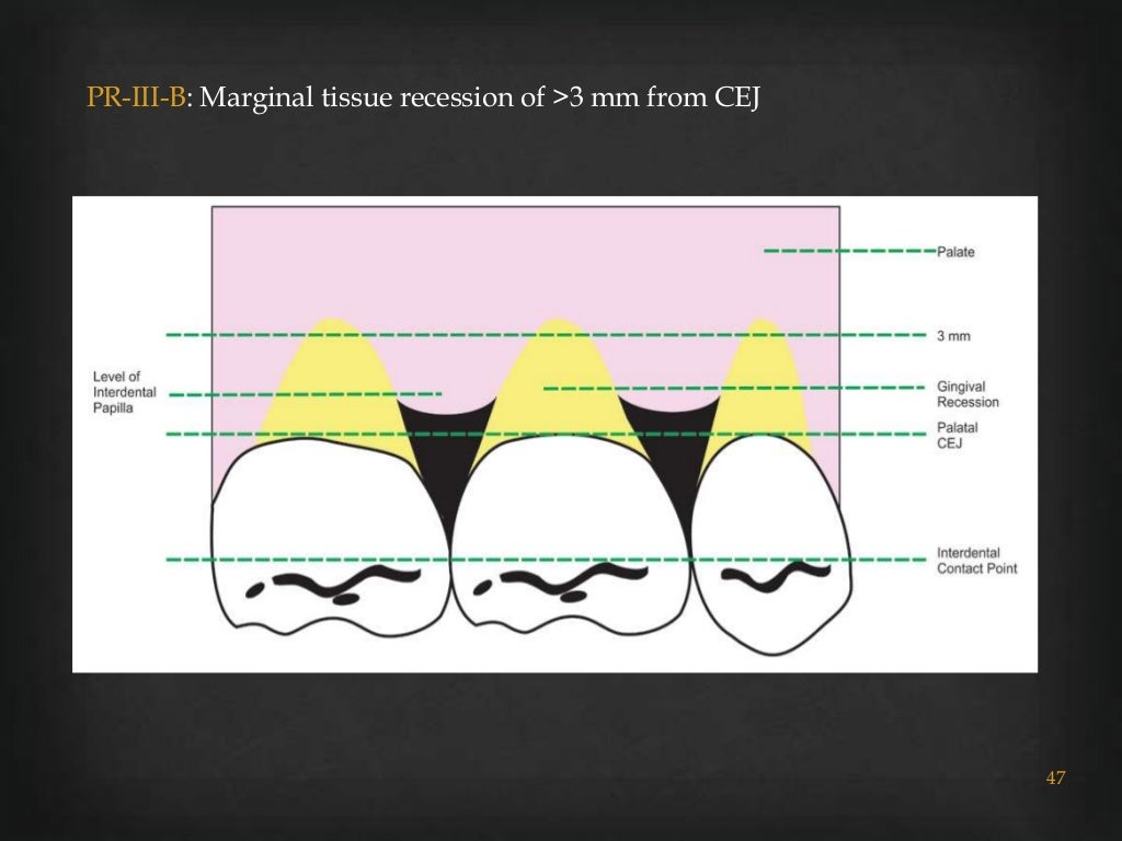 Gingival recession classifications
