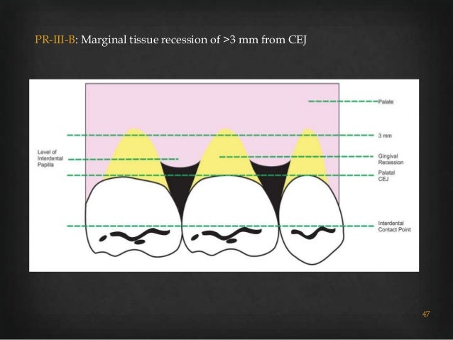 Gingival recession classifications