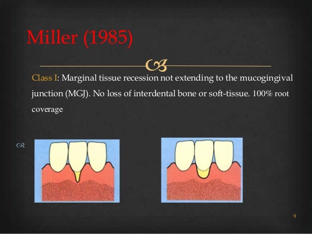 Gingival recession classifications