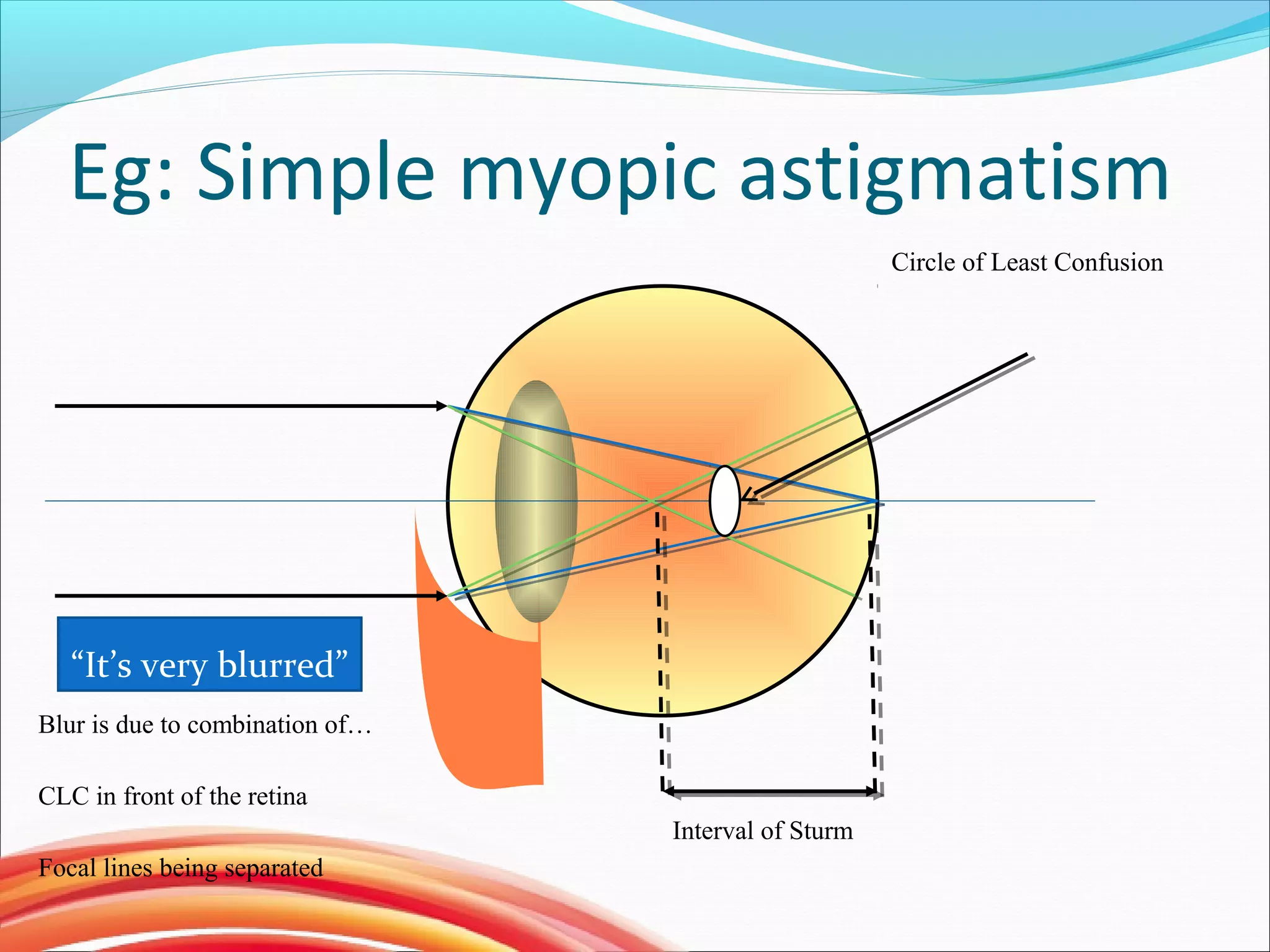 JCC -Jackson Cross Cylinder | PPT