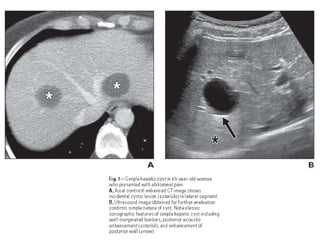 Cystic hepatic lesions | PPTX