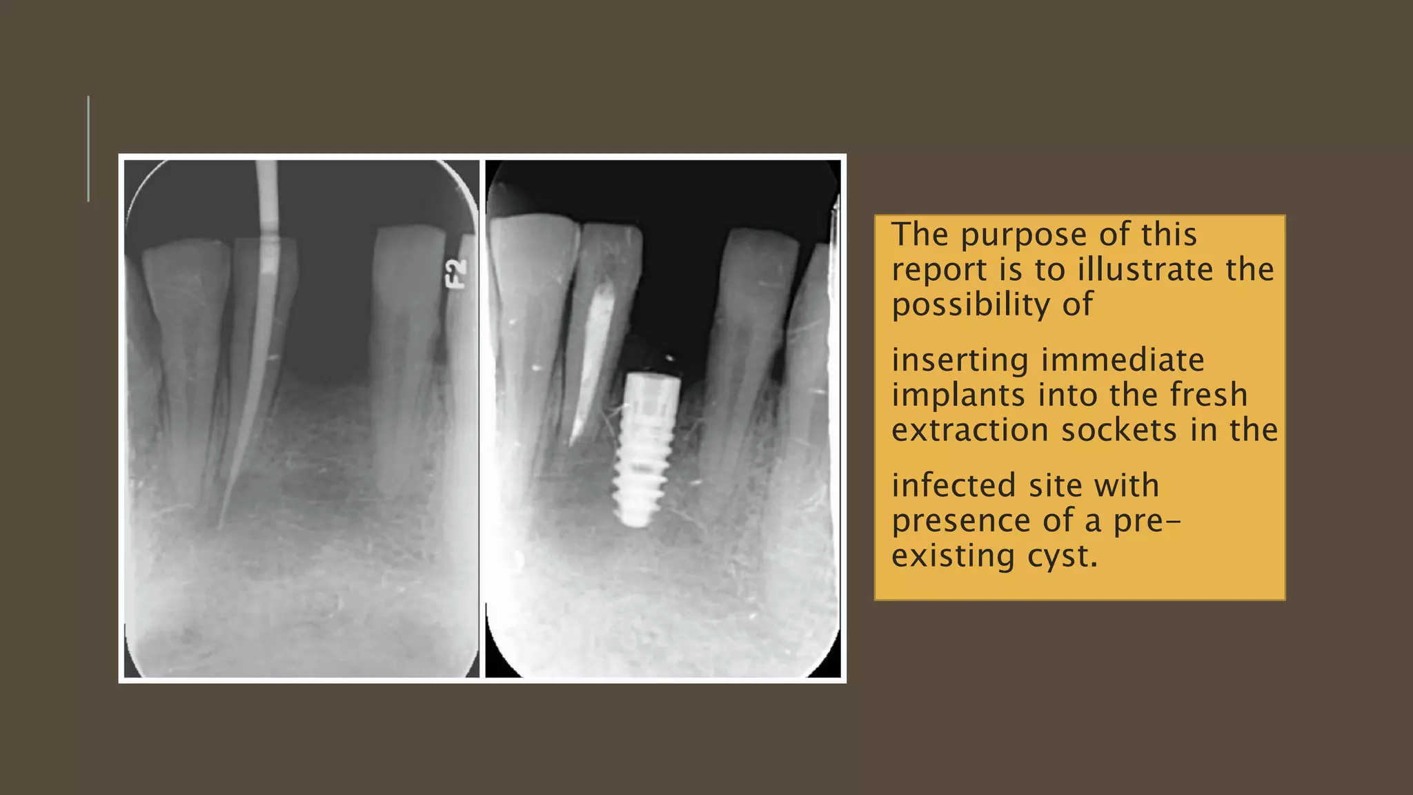 Jc cyst vs implant | PPTX