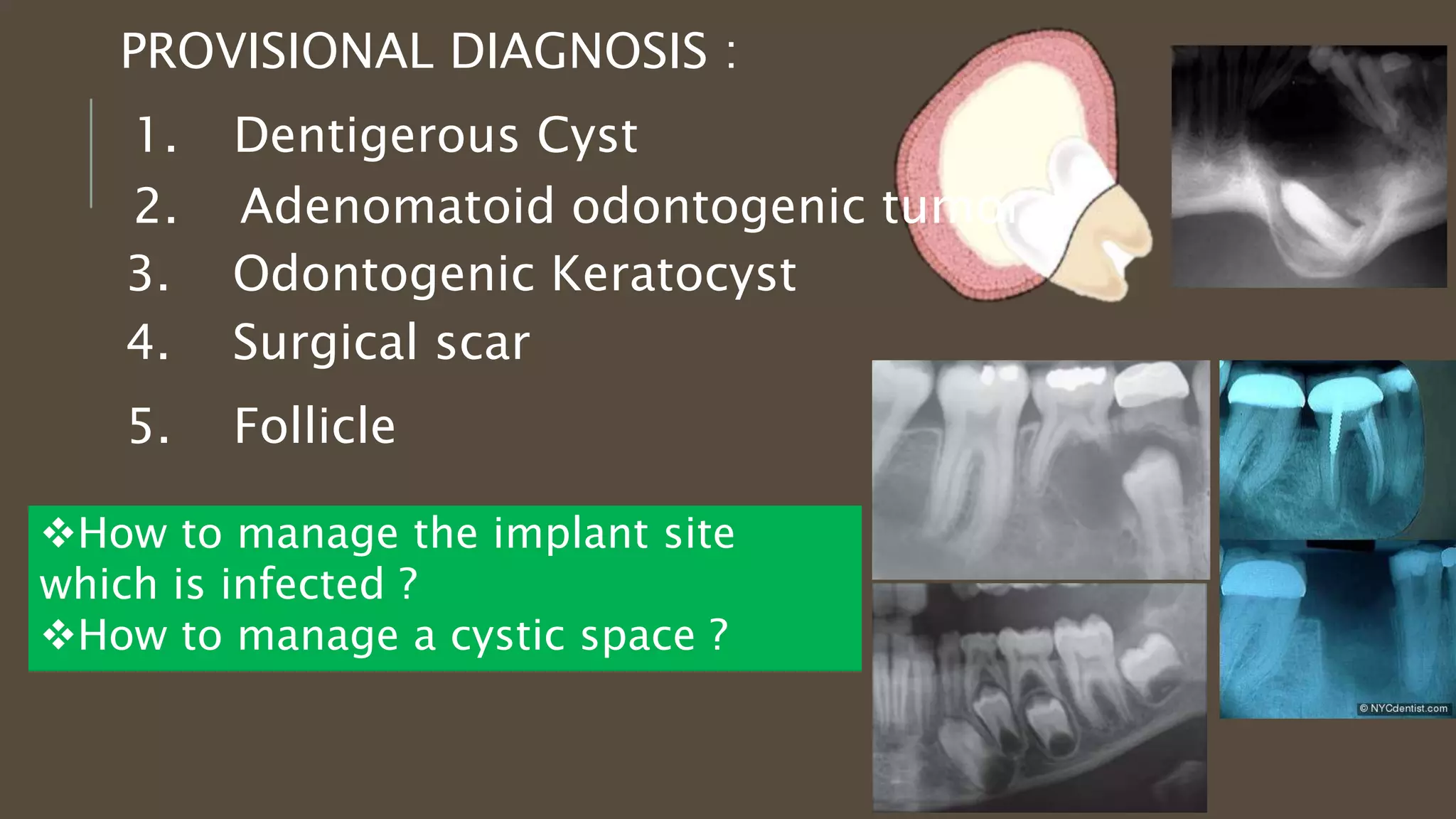 Jc cyst vs implant | PPTX