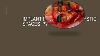 Jc cyst vs implant | PPT