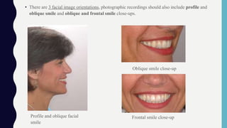 DYNAMIC SMILE ASSESSMENT | PPTX