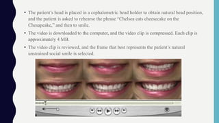 DYNAMIC SMILE ASSESSMENT | PPTX