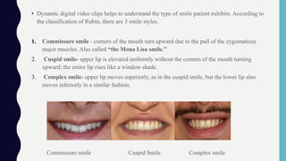 DYNAMIC SMILE ASSESSMENT | PPTX