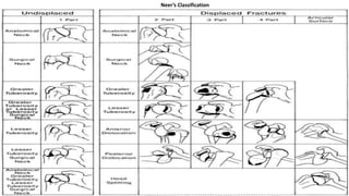 Jc factors that influence reduction loss in proximal humerus fracture ...