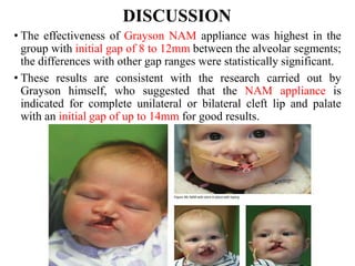 nasoalveolar molding | PPTX