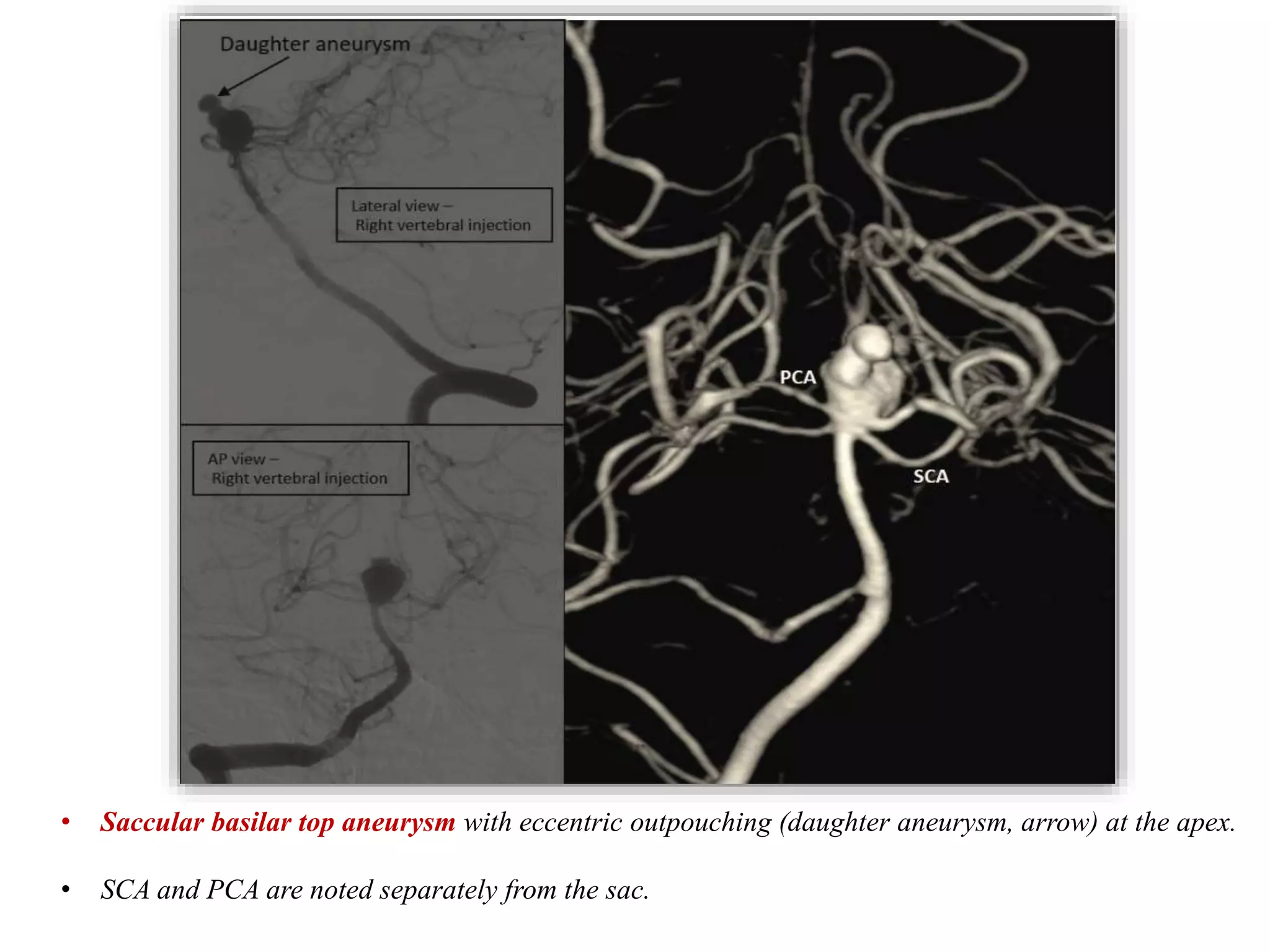 Digital Subtraction Neuroangiography: What a Resident Should Know | PPTX