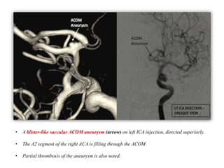 Digital Subtraction Neuroangiography: What a Resident Should Know | PPT