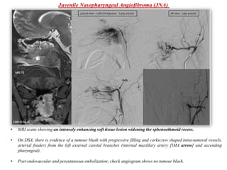 Digital Subtraction Neuroangiography: What a Resident Should Know | PPT