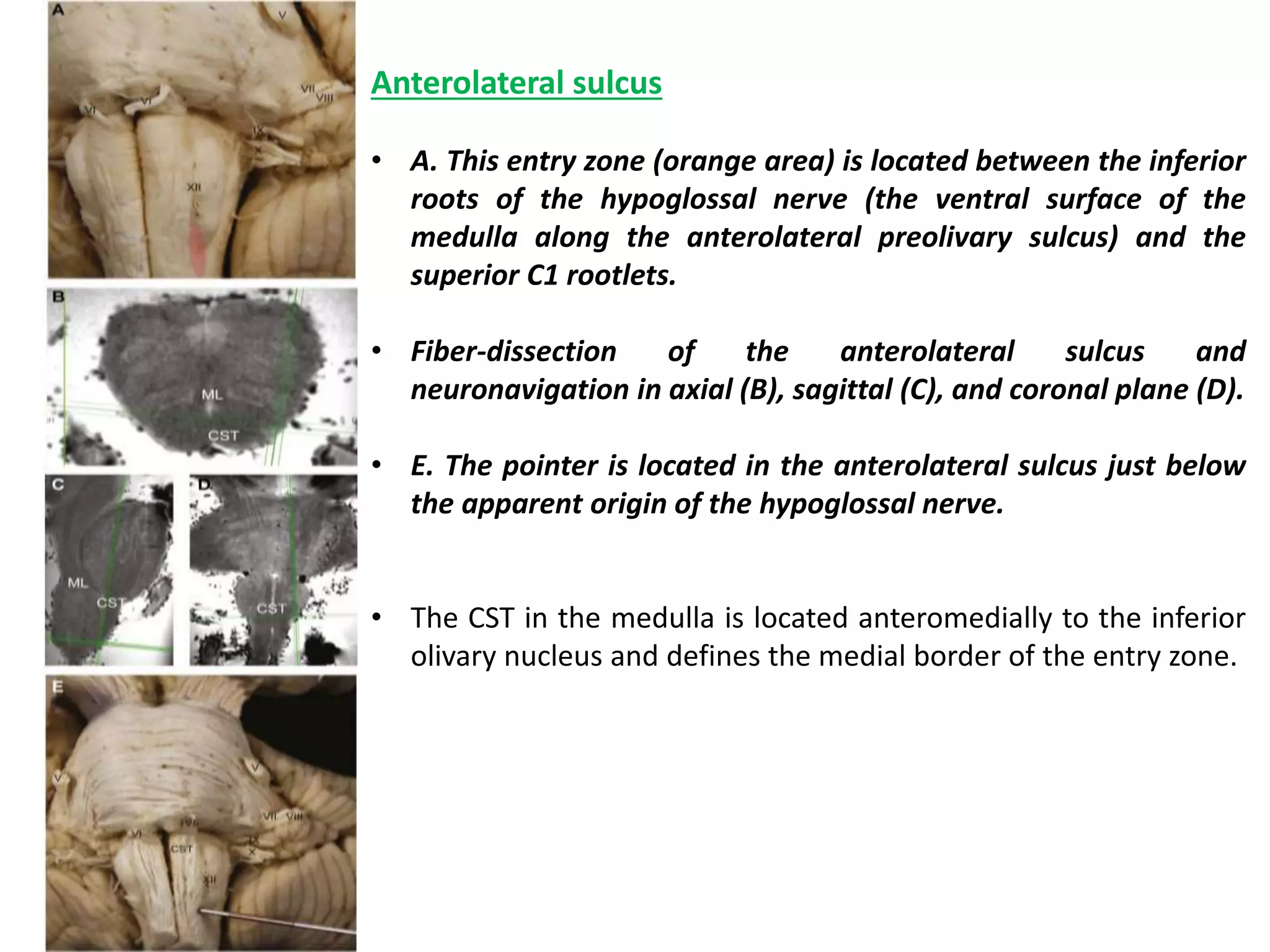 Endoscopic Endonasal Transclival Approach to the Ventral Brainstem | PPT