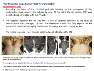 Endoscopic Endonasal Transclival Approach to the Ventral Brainstem | PPT