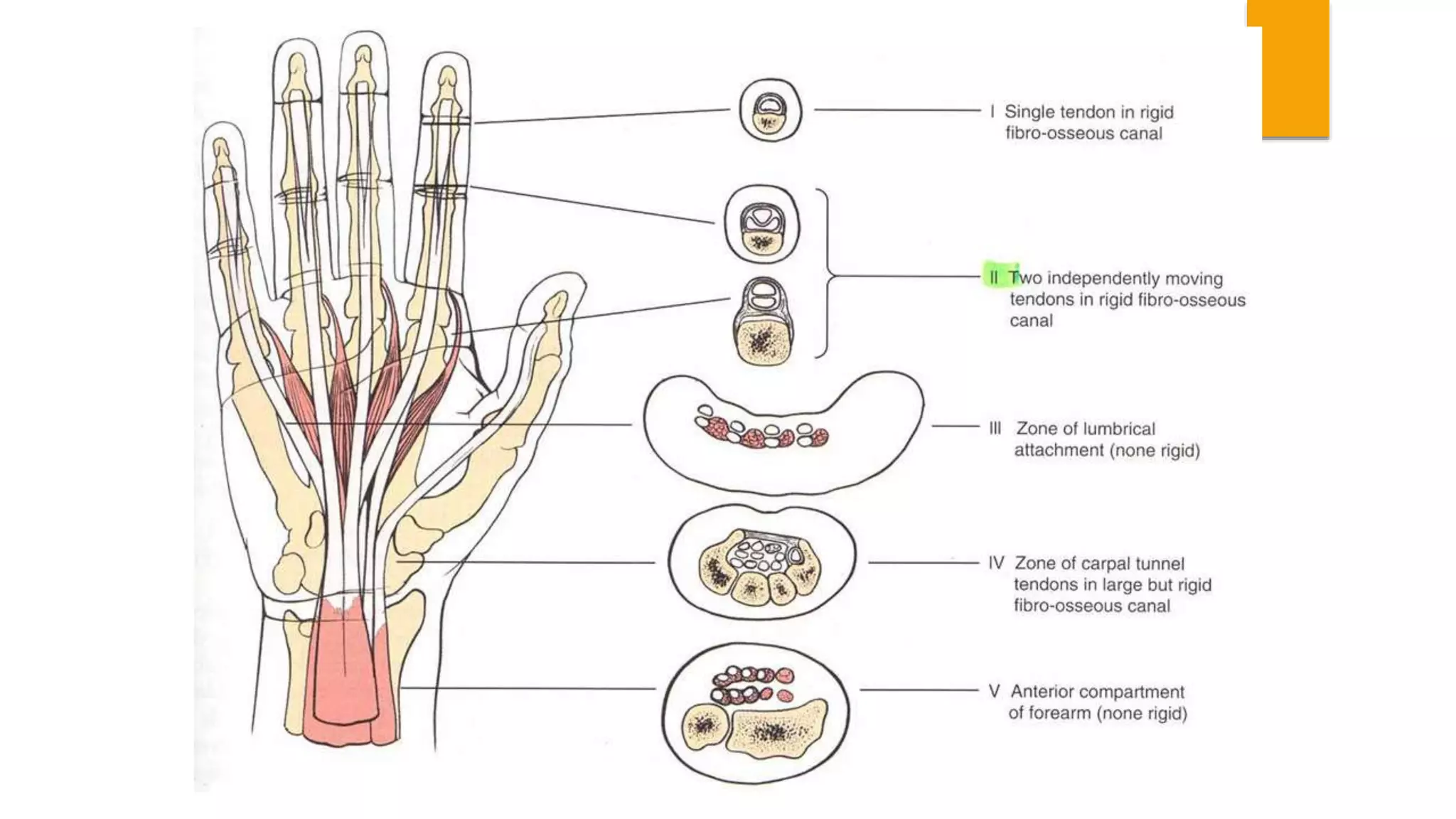 Jc flexor tendon injury, repair & rehabilitaion | PPTX