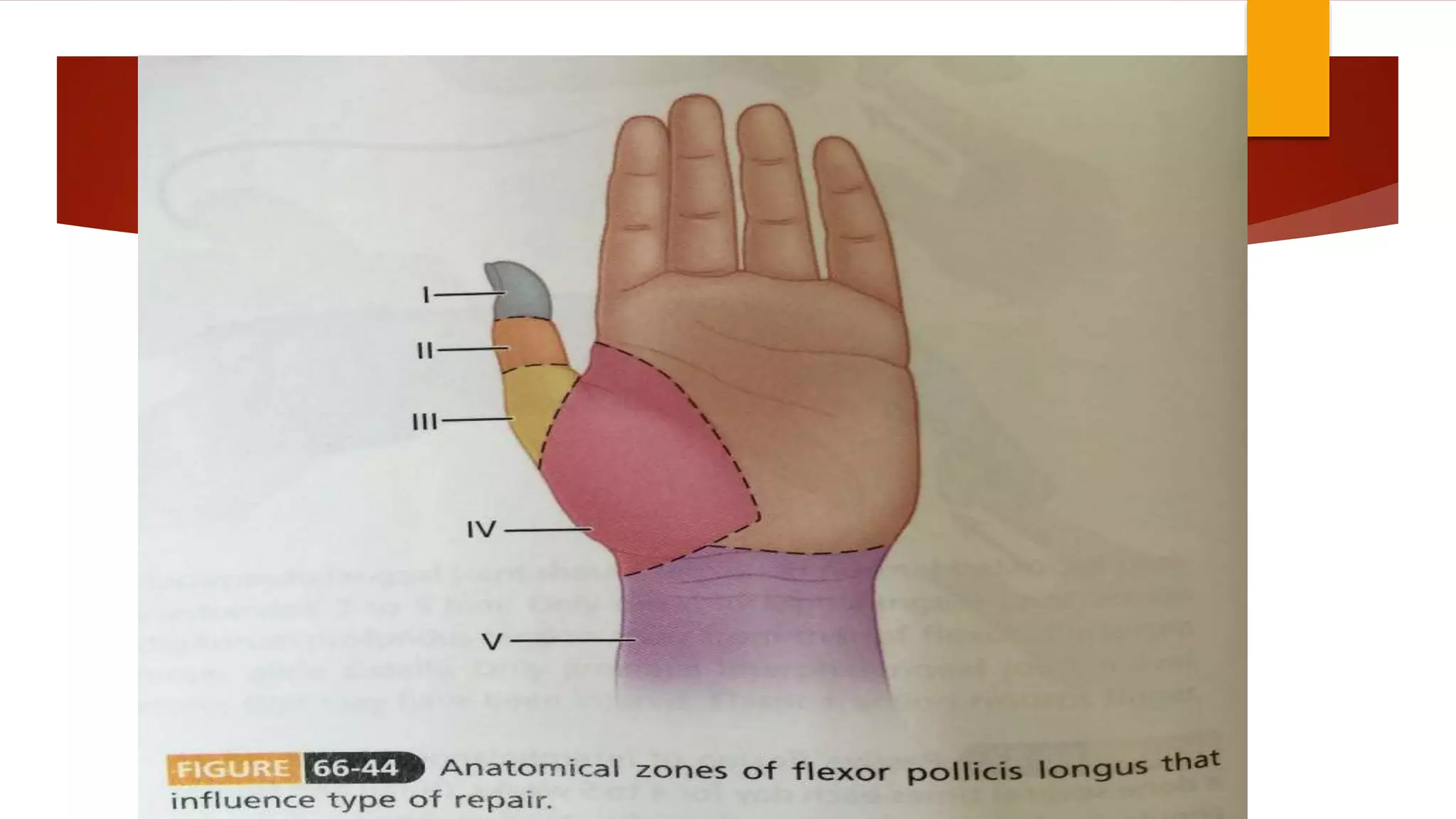 Jc flexor tendon injury, repair & rehabilitaion | PPTX