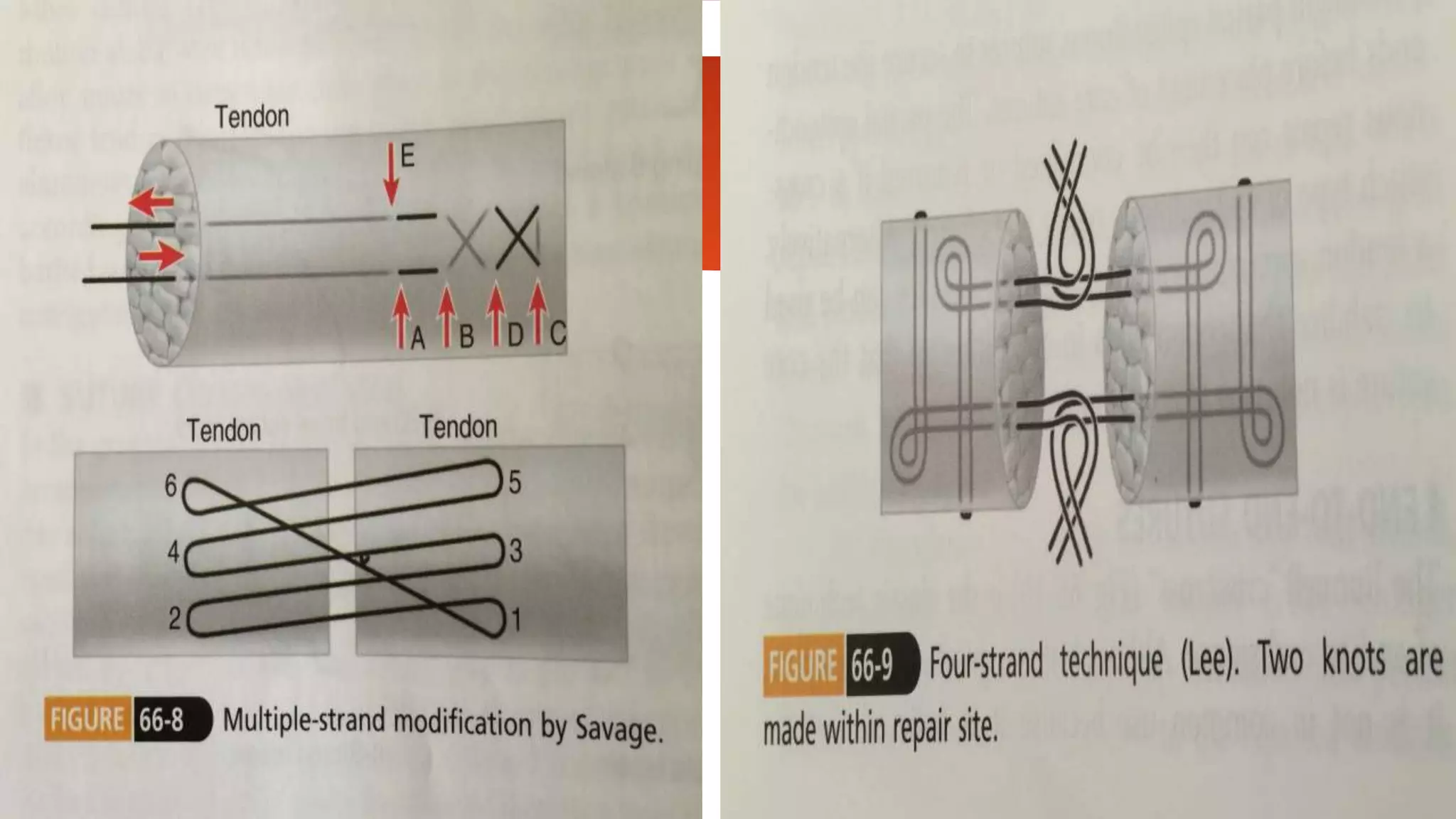 Jc flexor tendon injury, repair & rehabilitaion | PPTX