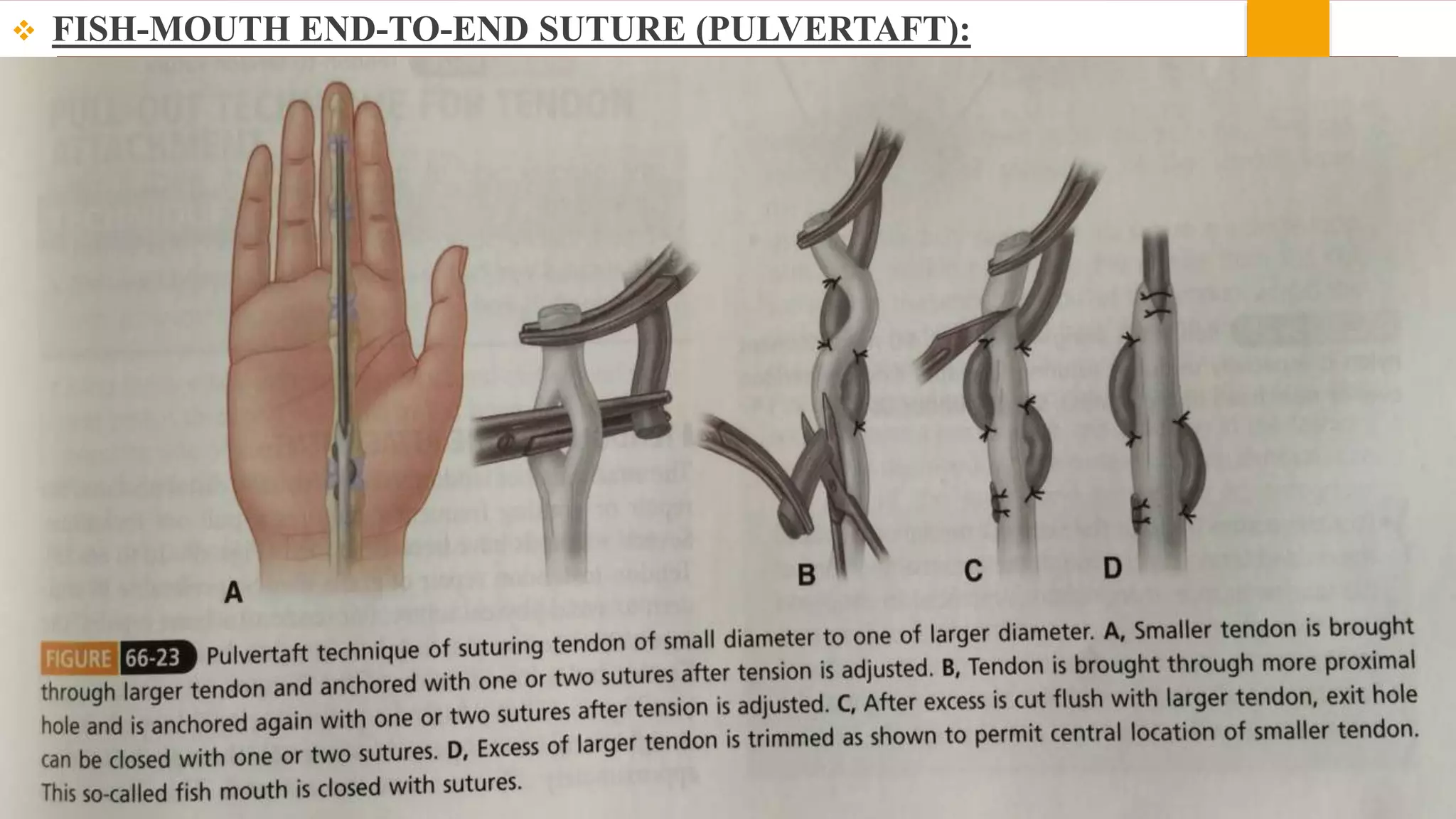 Jc flexor tendon injury, repair & rehabilitaion | PPT