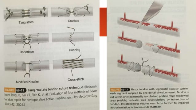Jc flexor tendon injury, repair & rehabilitaion | PPTX