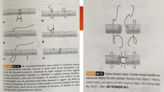 Jc flexor tendon injury, repair & rehabilitaion | PPTX