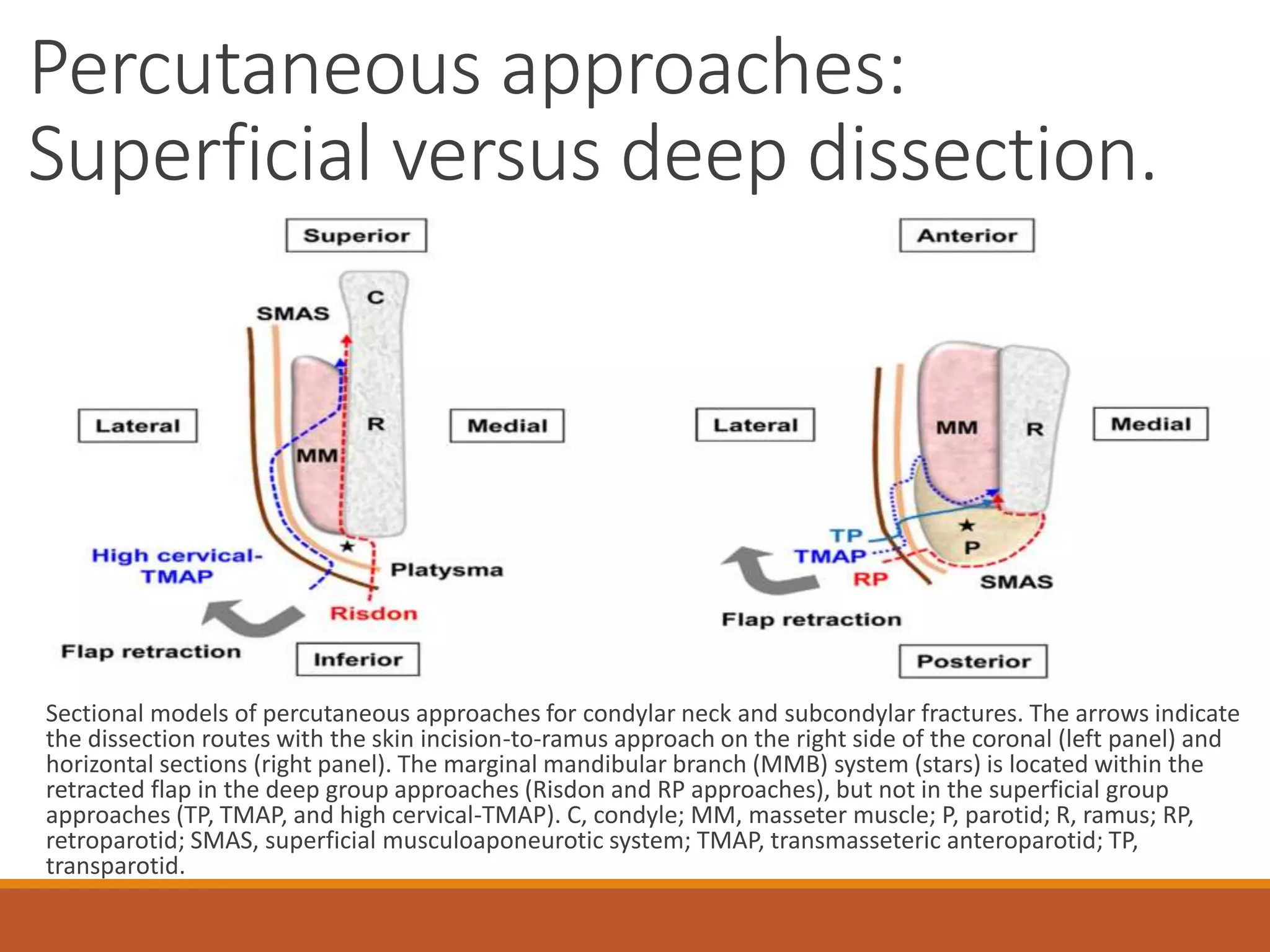 Surgical approaches for condylar fractures related to facial nerve ...