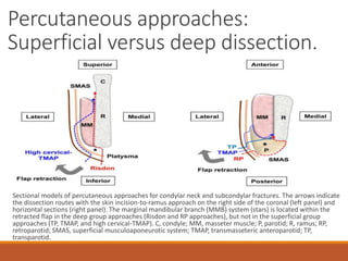 Surgical approaches for condylar fractures related to facial nerve ...