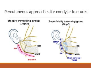Surgical approaches for condylar fractures related to facial nerve ...