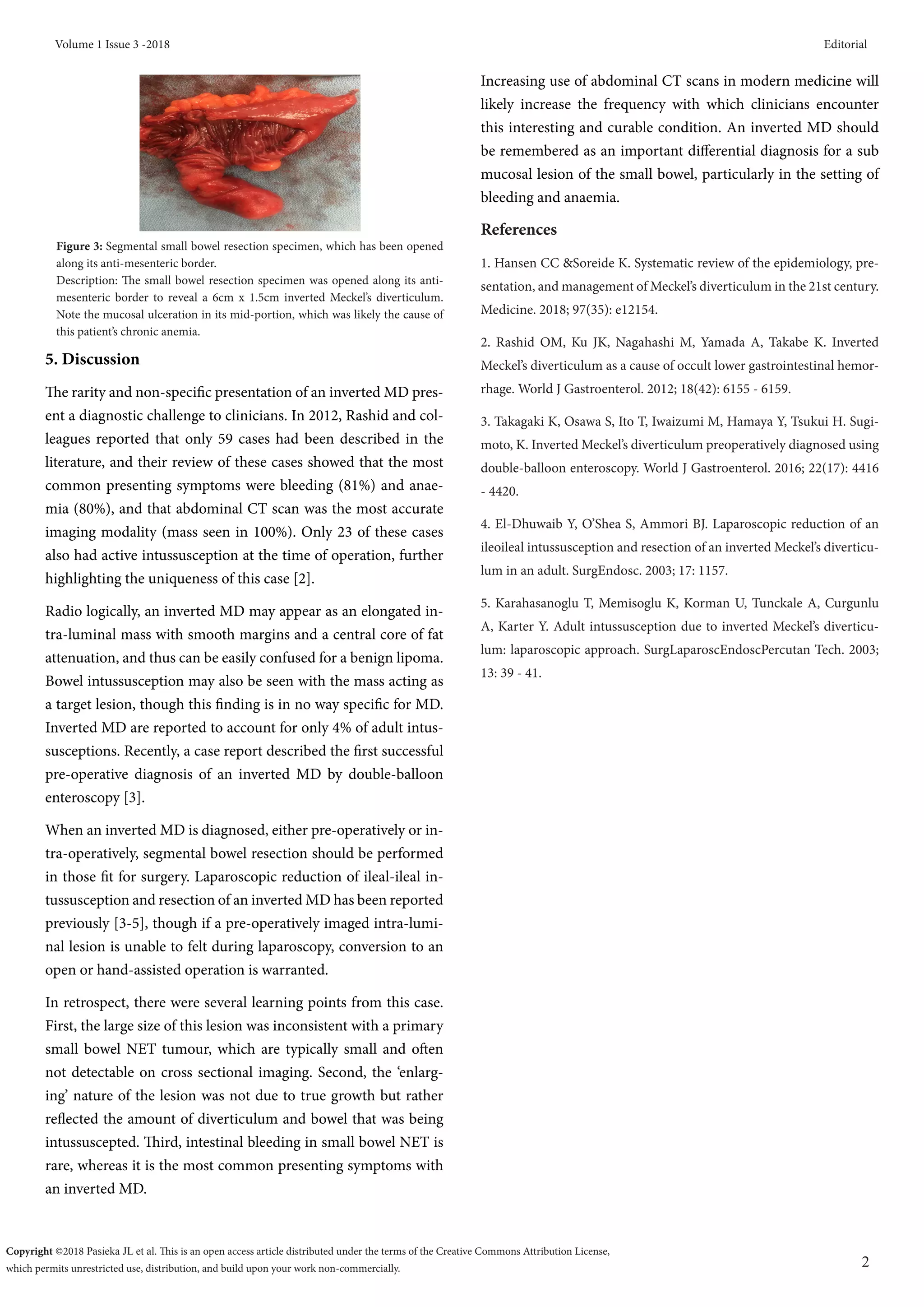Inverted Meckel’s Diverticulum: A Rare Cause of Chronic Anaemia | PDF