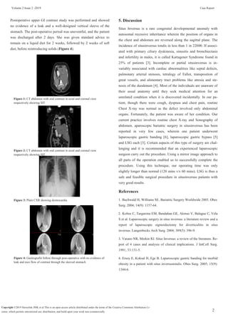 Laparoscopic Sleeve Gastrectomy in Situs Inversus Totalis | PDF