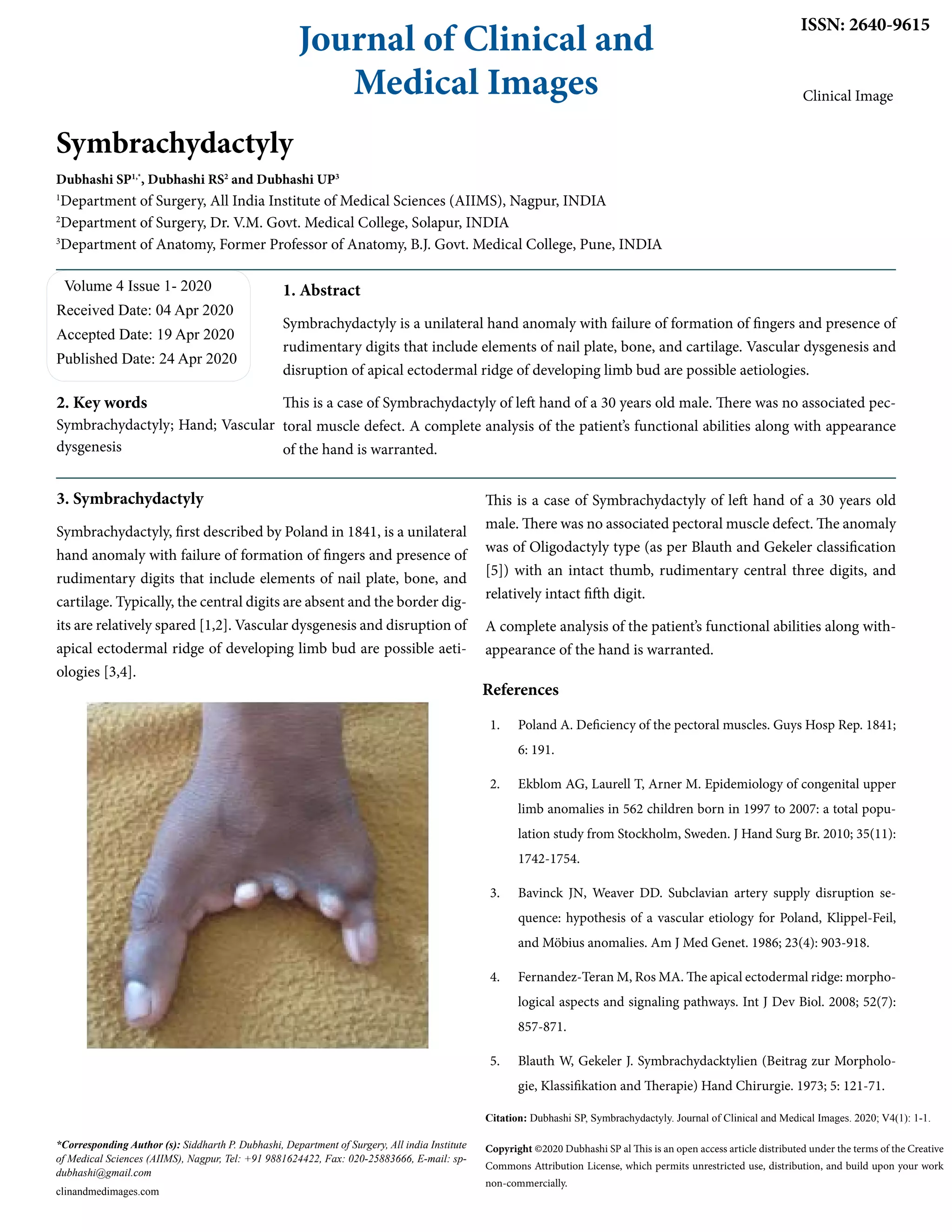 Symbrachydactyly | PDF