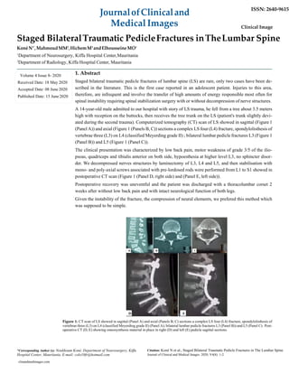 Staged BilateralTraumatic PedicleFractures inTheLumbar Spine | PDF