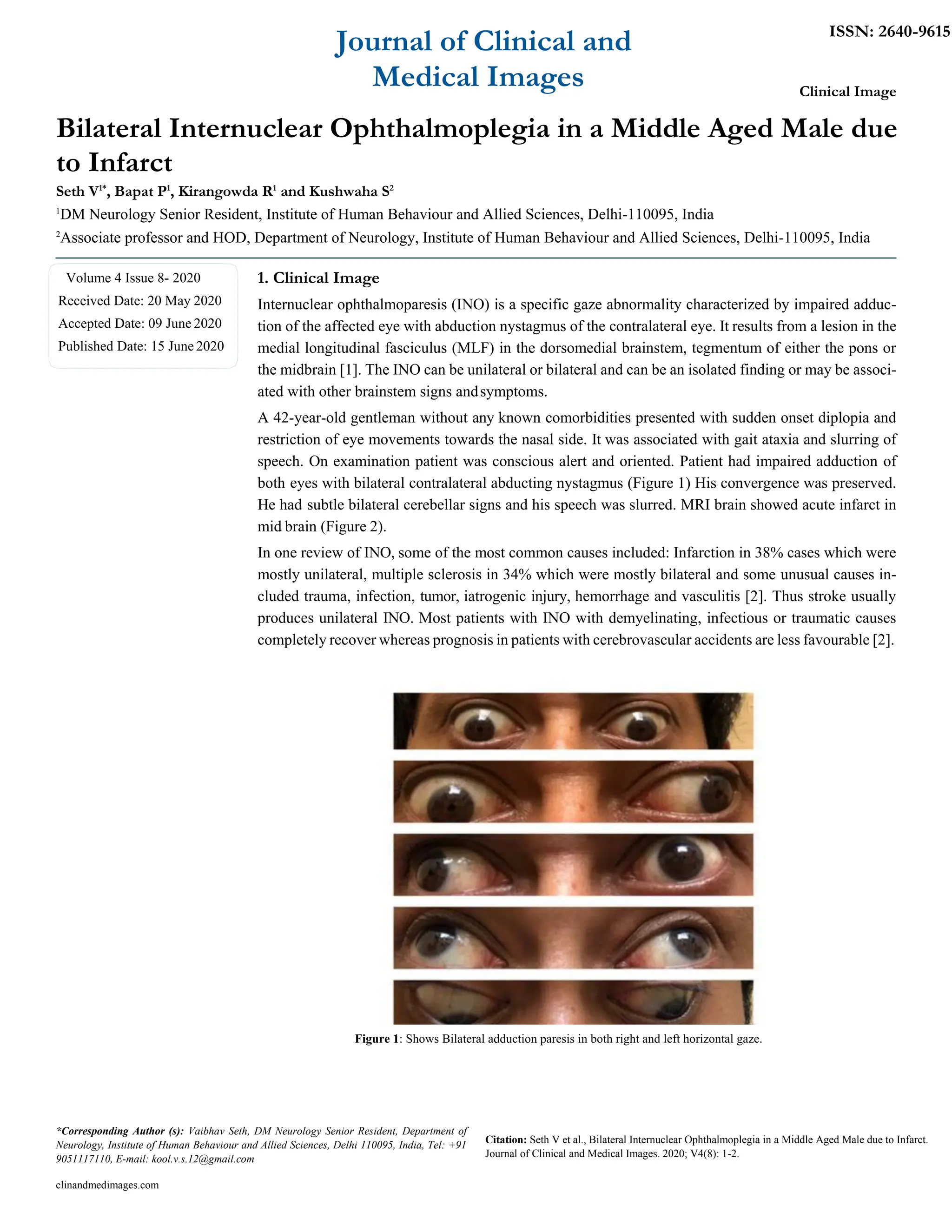 Bilateral Internuclear Ophthalmoplegia in a Middle Aged Male due to ...