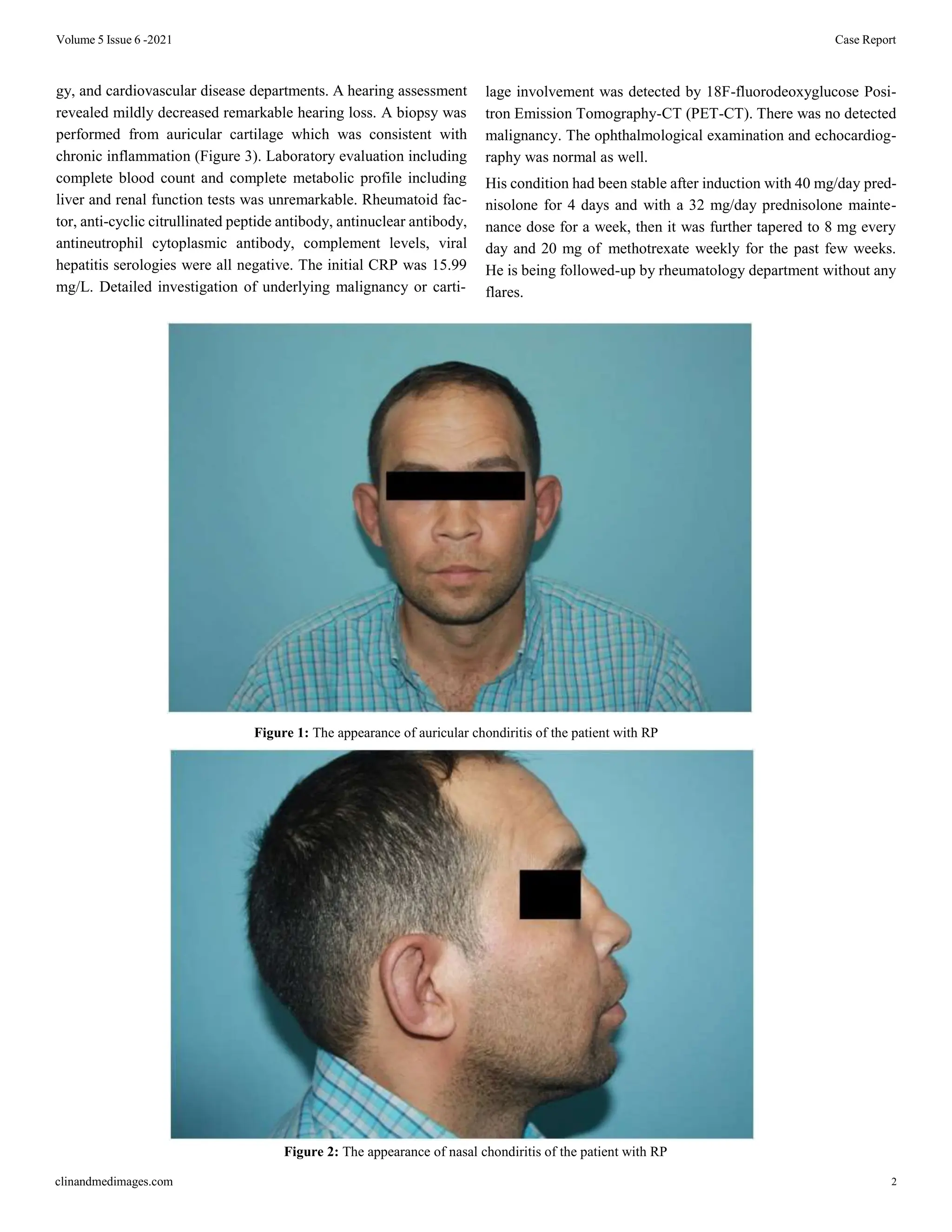 Relapsing Polychondritis Case: An Important Diagnosis Not to Be Delayed ...