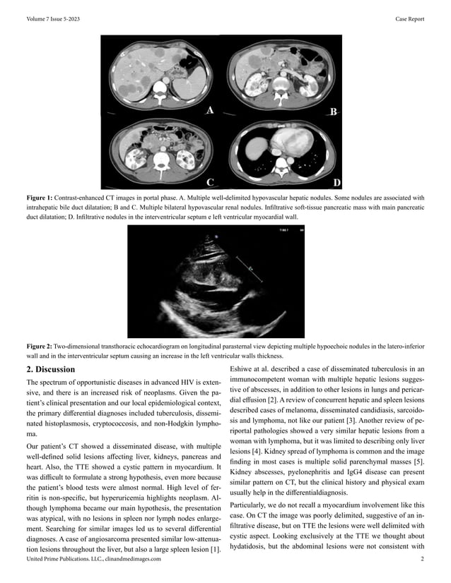 Imaging of Diffuse B Cell Large Lymphoma in Liver, Kidneys, Pancreas ...