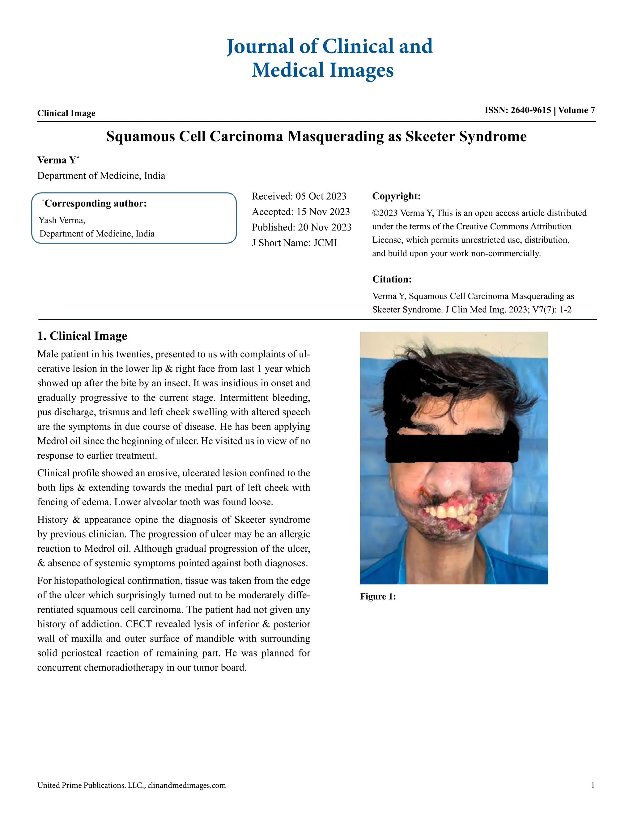 Squamous Cell Carcinoma Masquerading as Skeeter Syndrome | PDF