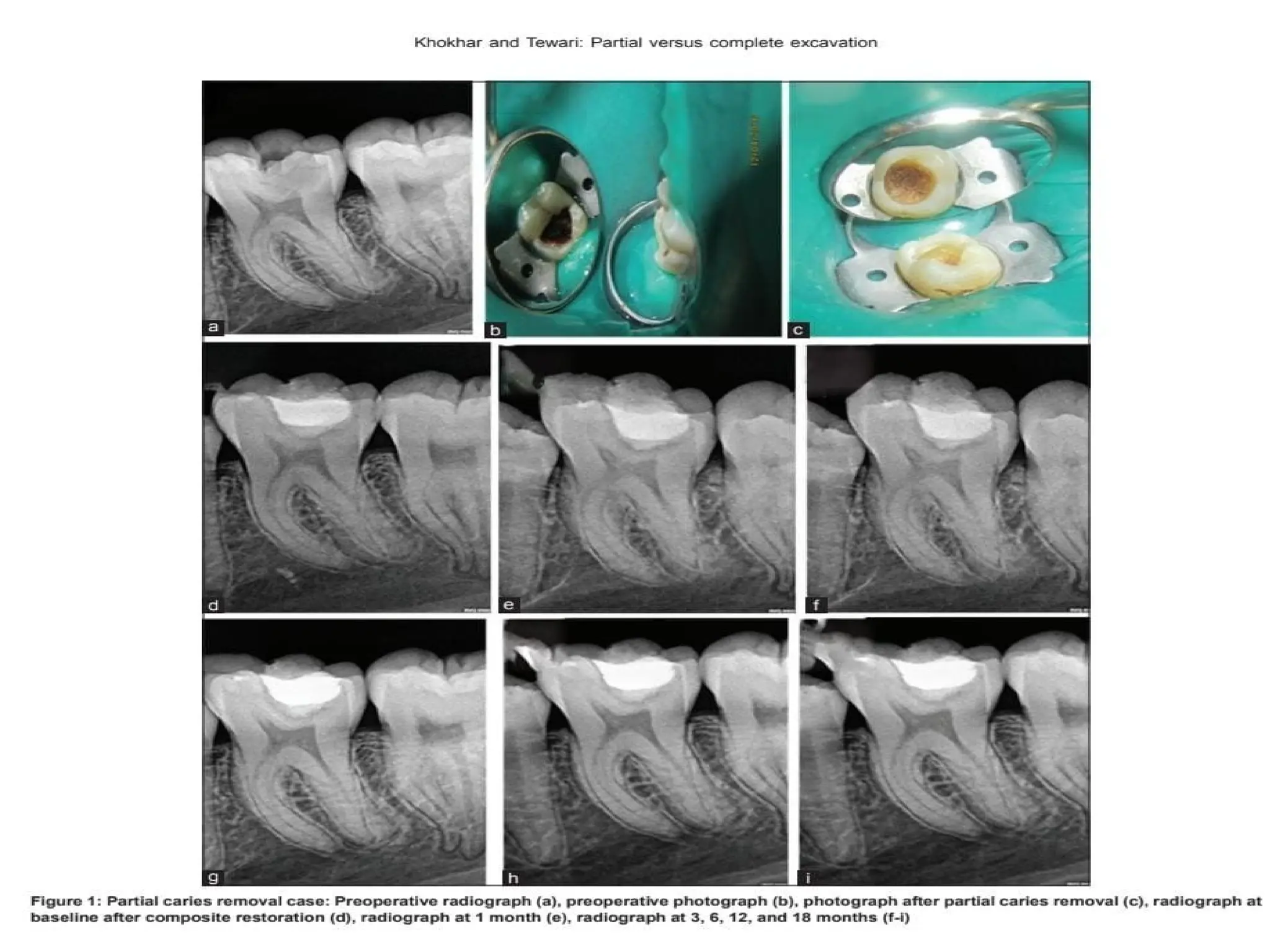 Jc Minimally Invasive Technique Dentistrypptx 8967