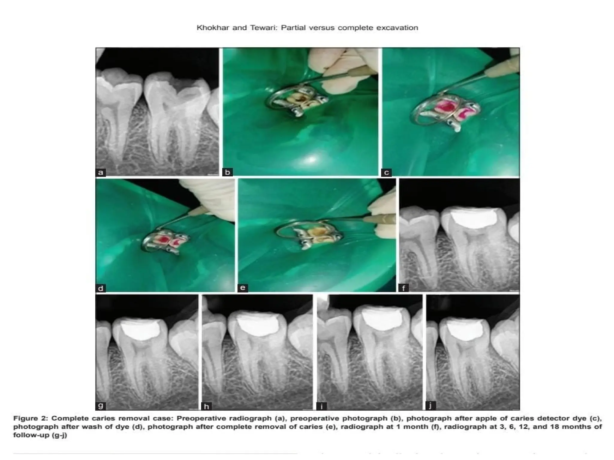 JC MINIMALLY INVASIVE technique DENTISTRY.pptx