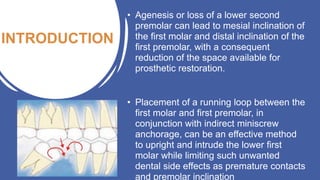 JC molar uprighting.pptx | Dental Health | Diseases and Conditions