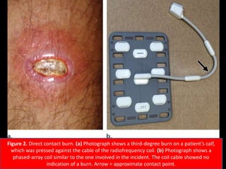 MRI safety | PPTX