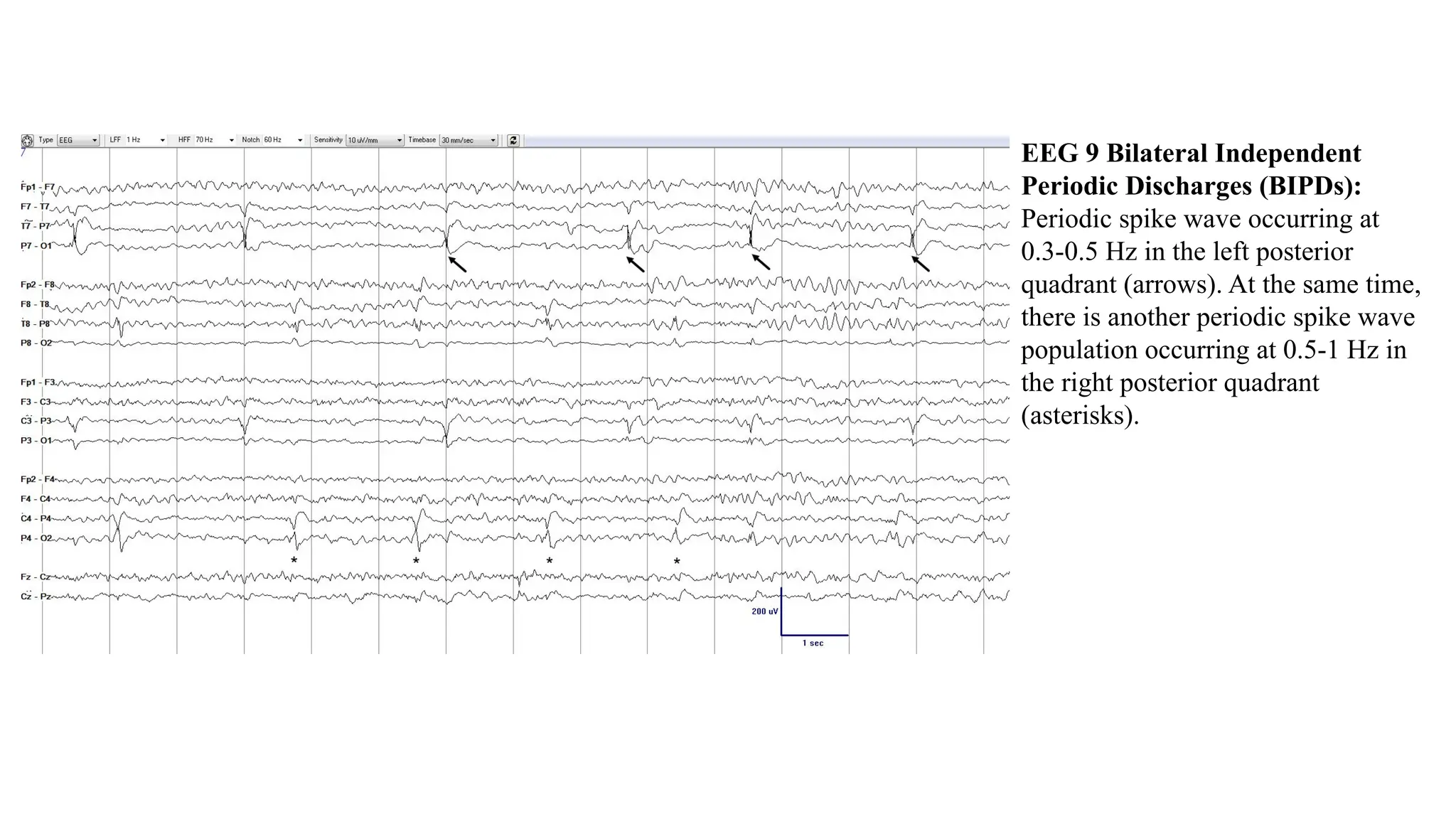 ACNS Standardized Critical Care EEG Terminology 2021 | PDF
