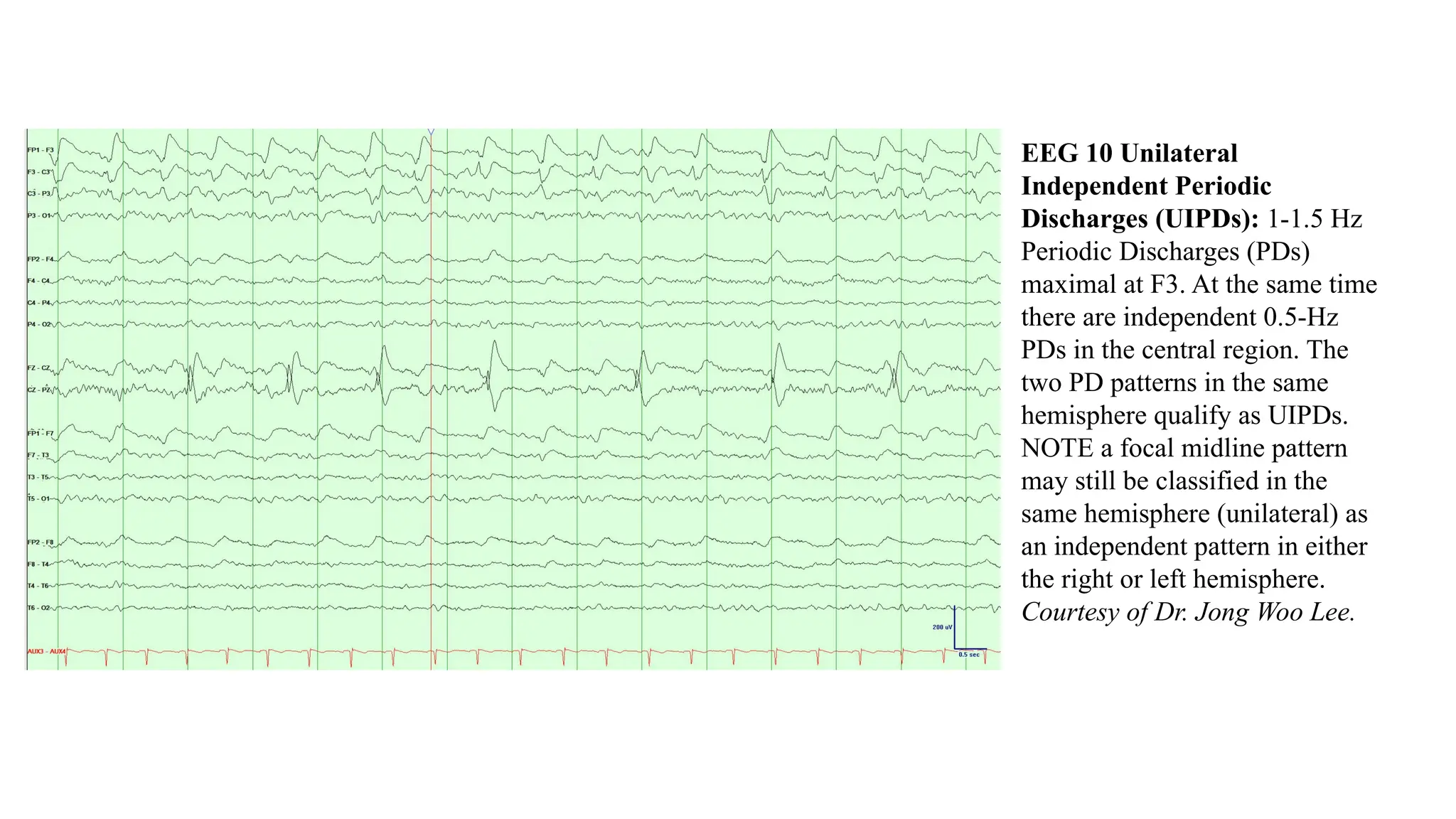 ACNS Standardized Critical Care EEG Terminology 2021 | PDF
