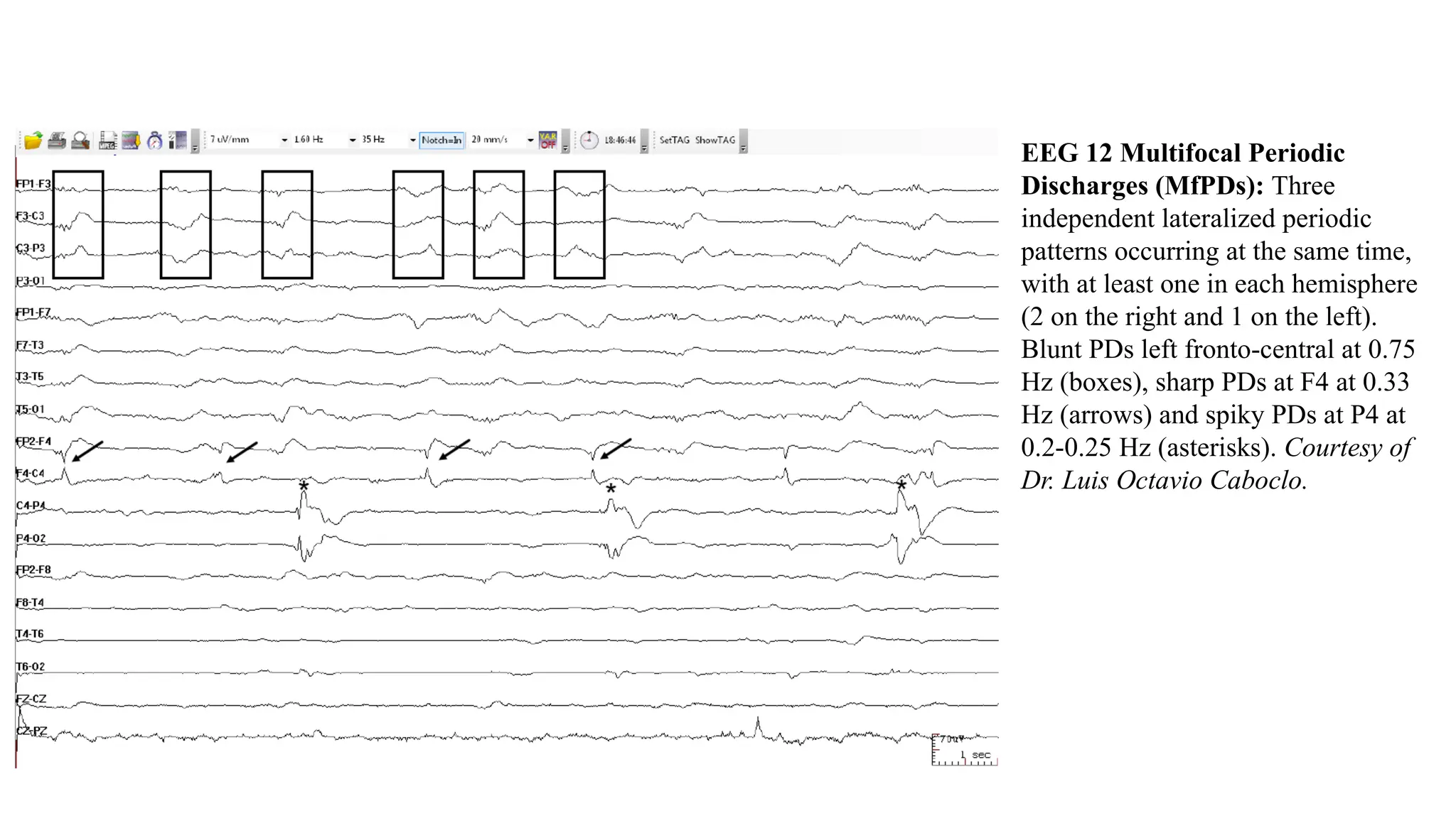 ACNS Standardized Critical Care EEG Terminology 2021 | PDF