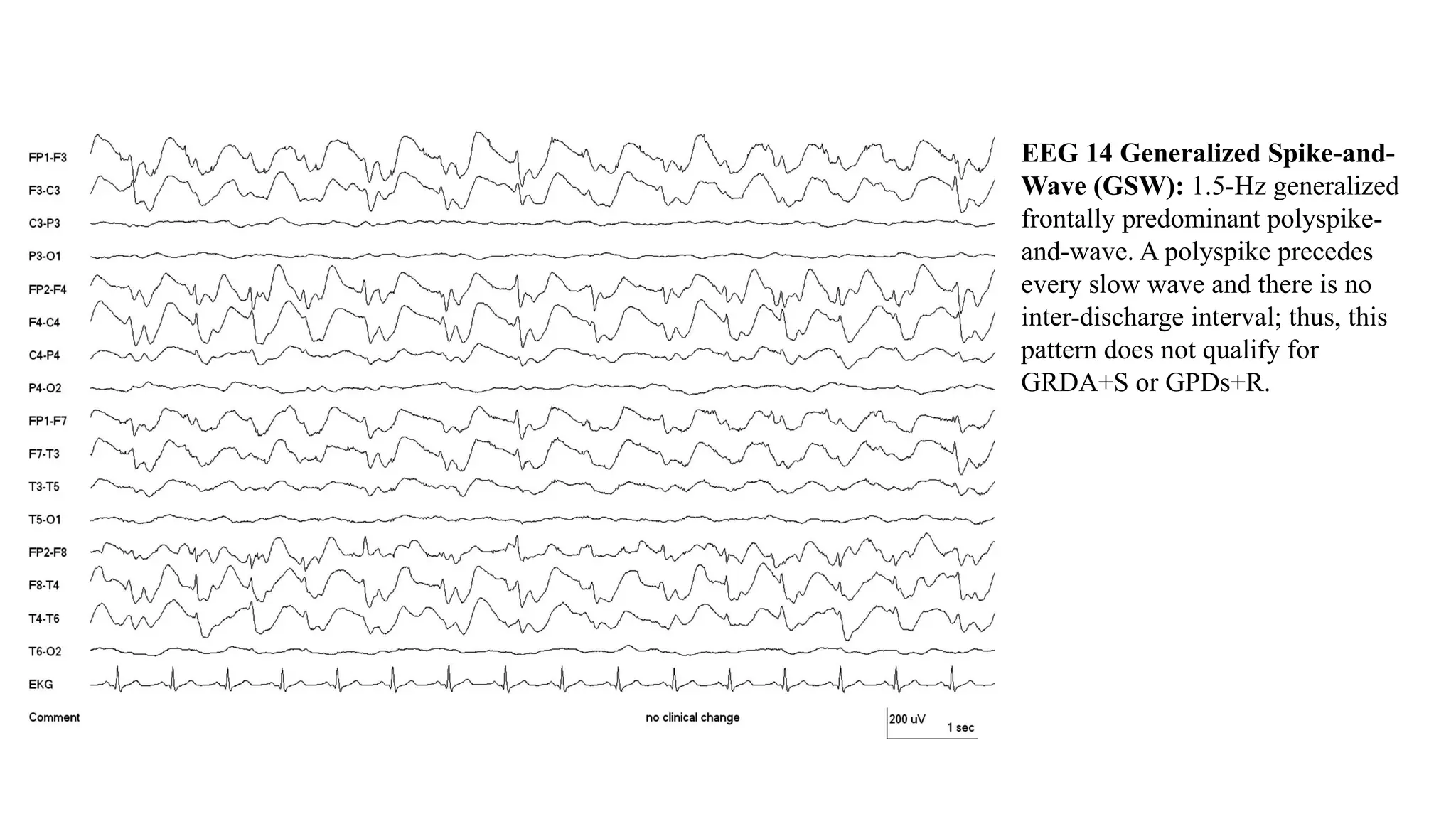 ACNS Standardized Critical Care EEG Terminology 2021 | PDF