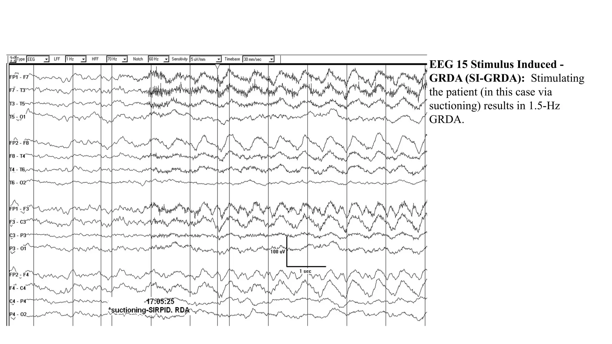 ACNS Standardized Critical Care EEG Terminology 2021 | PDF
