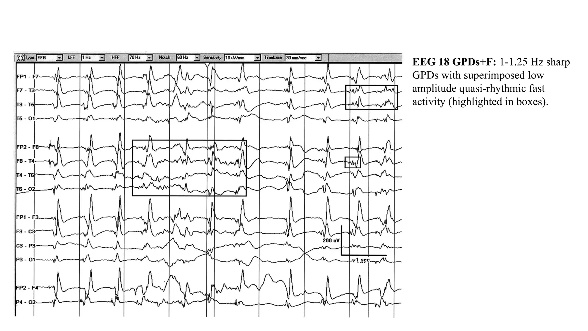 ACNS Standardized Critical Care EEG Terminology 2021 | PDF