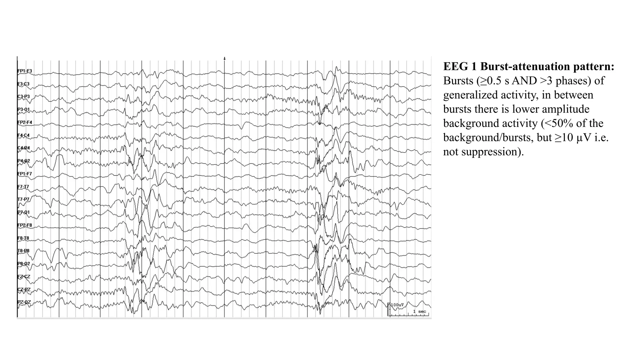 ACNS Standardized Critical Care EEG Terminology 2021 | PDF