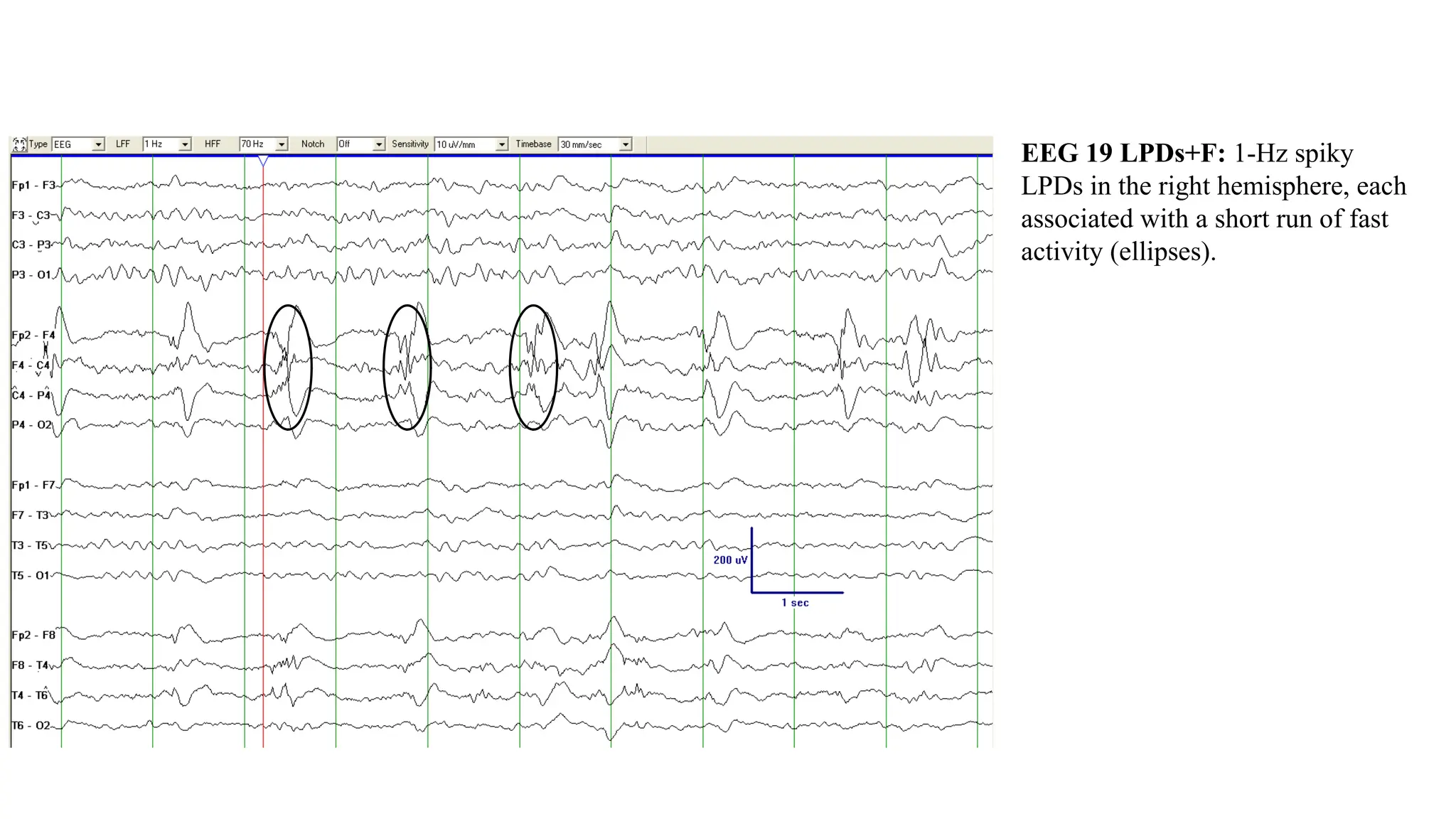 ACNS Standardized Critical Care EEG Terminology 2021 | PDF