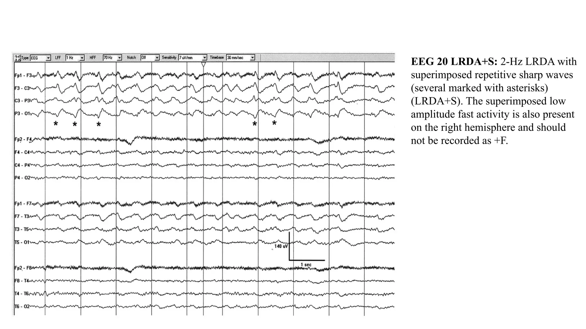 ACNS Standardized Critical Care EEG Terminology 2021 | PDF