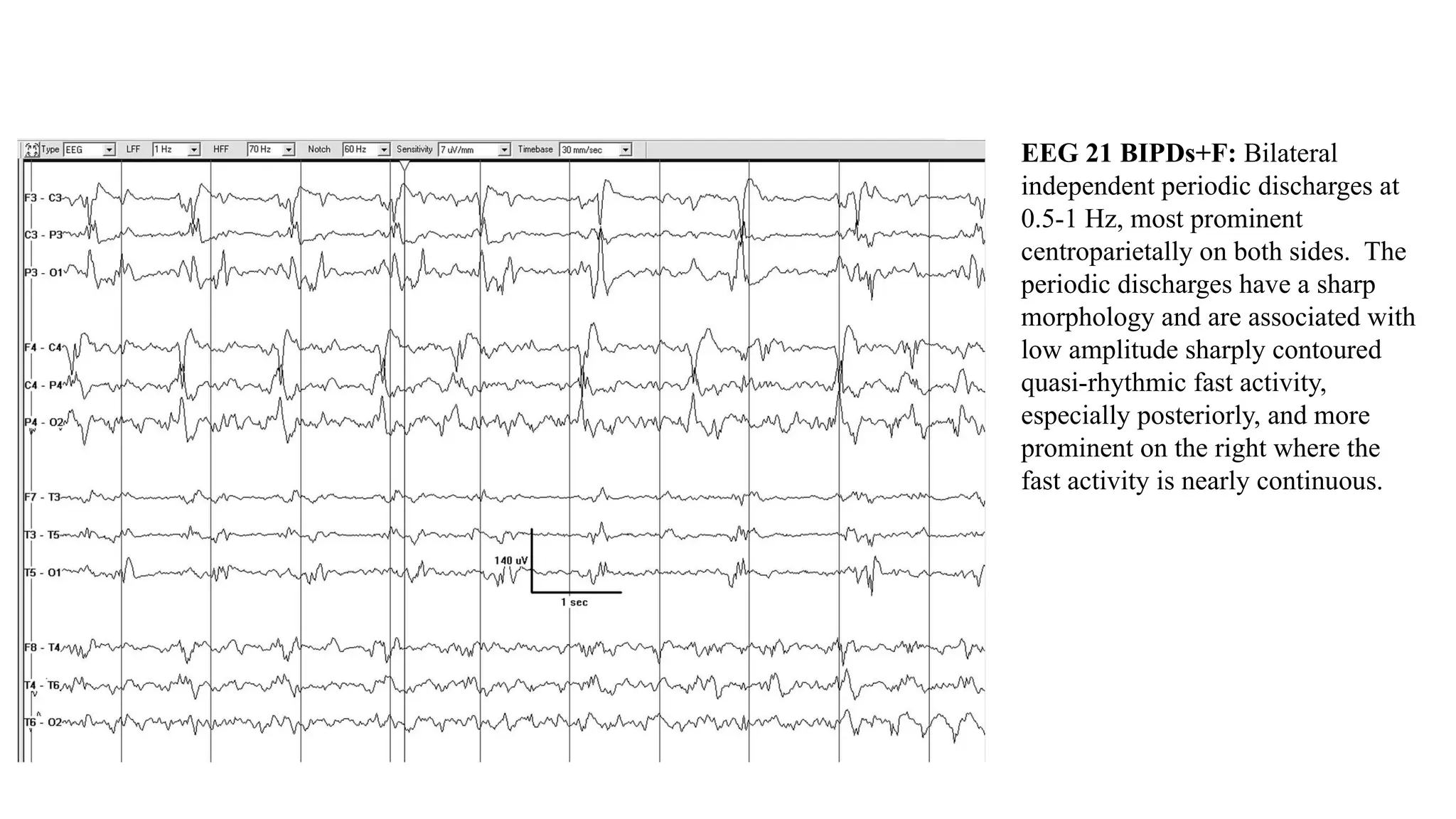 ACNS Standardized Critical Care EEG Terminology 2021 | PDF